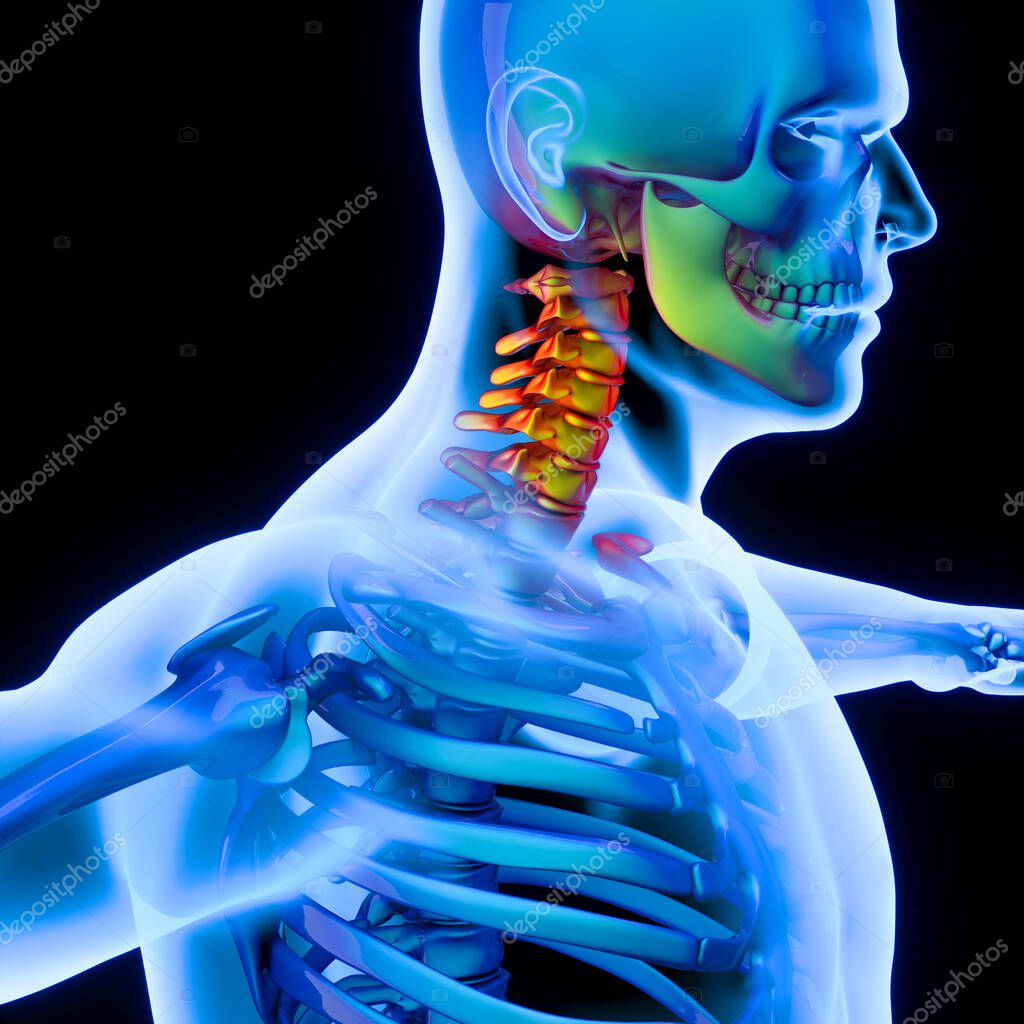 inflamación de la columna vertebral a las vértebras cervicales, rigidez ...