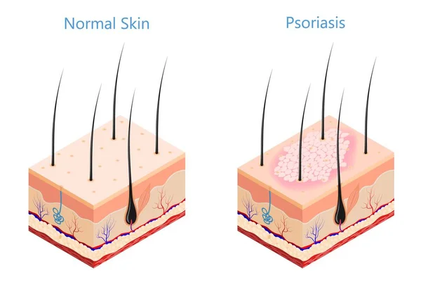 47 illustrations de Psoriasis en plaques | Depositphotos