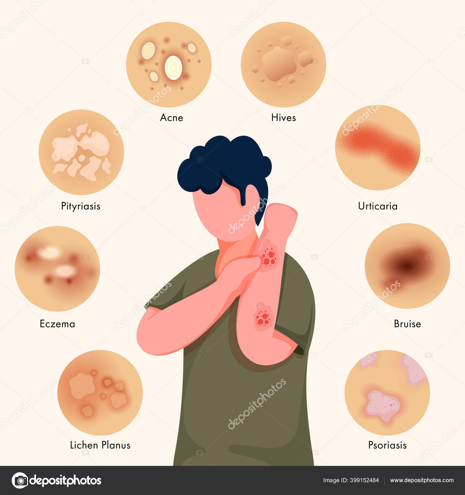 Faceless Young Boy Itching His Hands Showing Different Skin Rashes ...