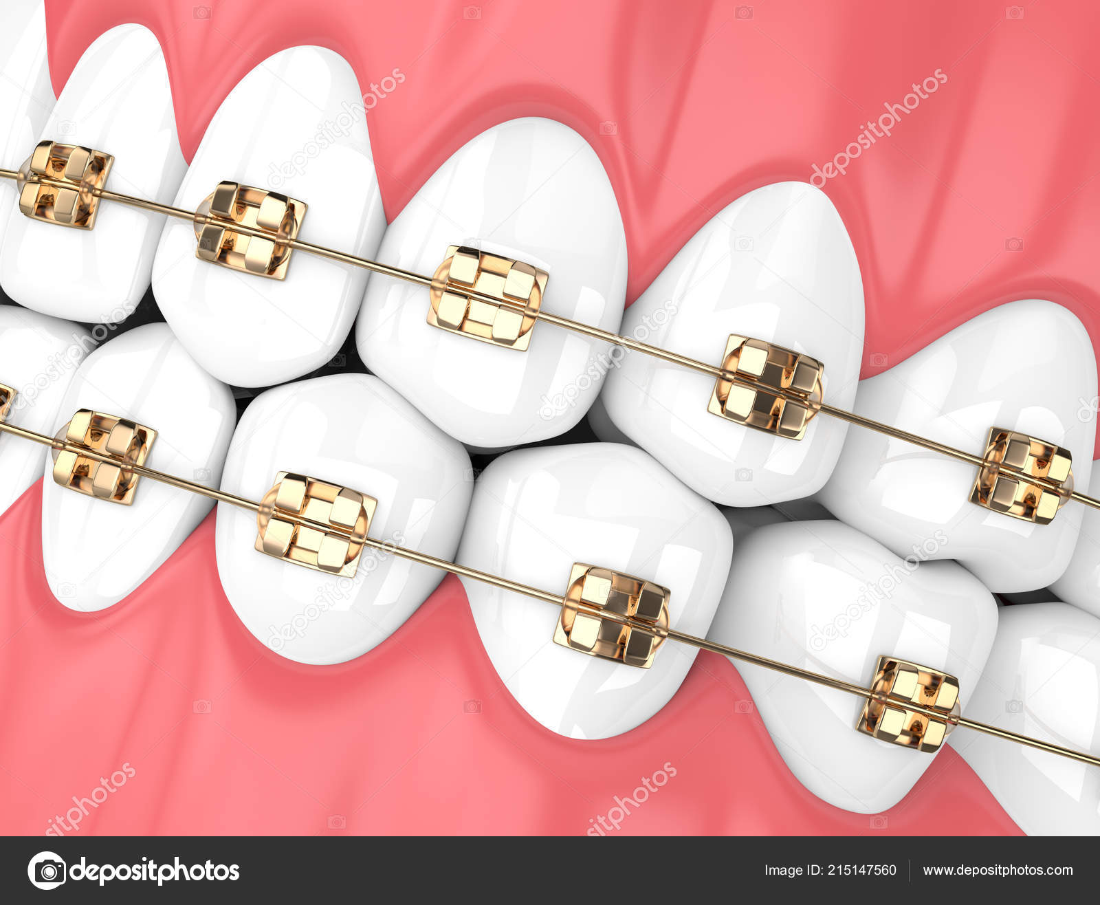Render Jaw Teeth Golden Orthodontic Braces Isolated White Background ...