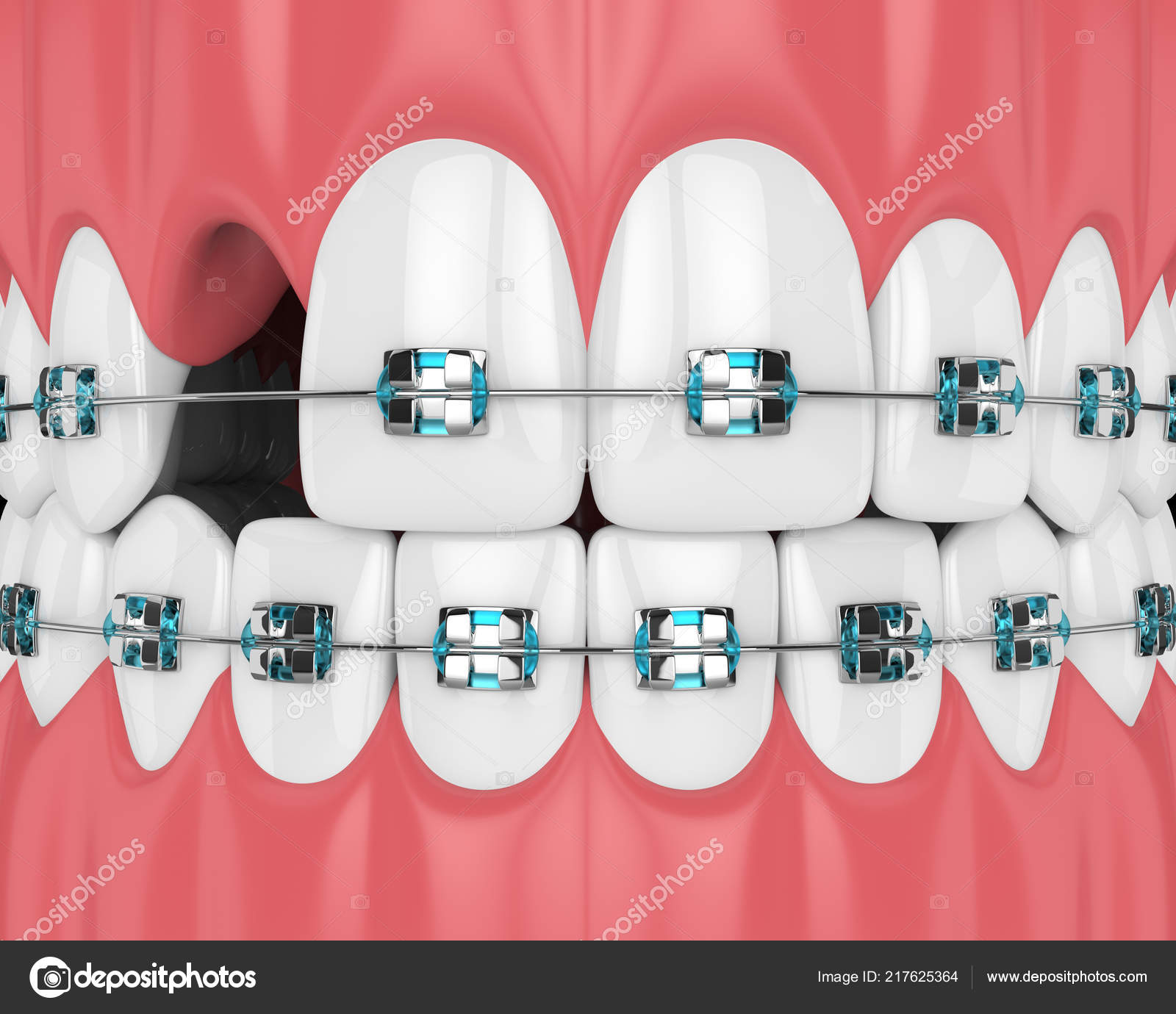 Render Teeth Braces Cavity Dental Treatment Concept — Stock Photo ...