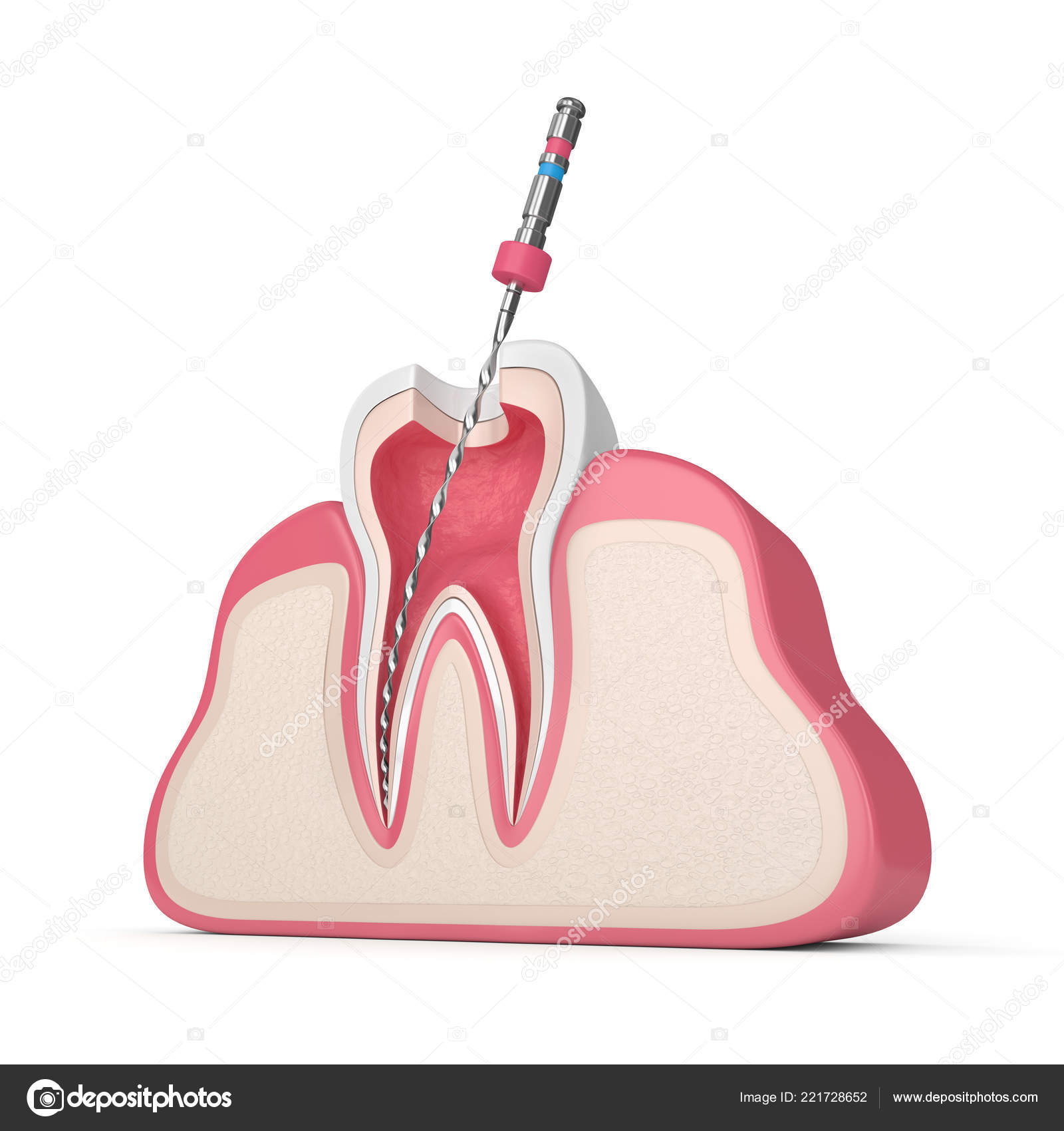 Render Tooth Endodontic File Gums White Background Root Canal Treatment ...