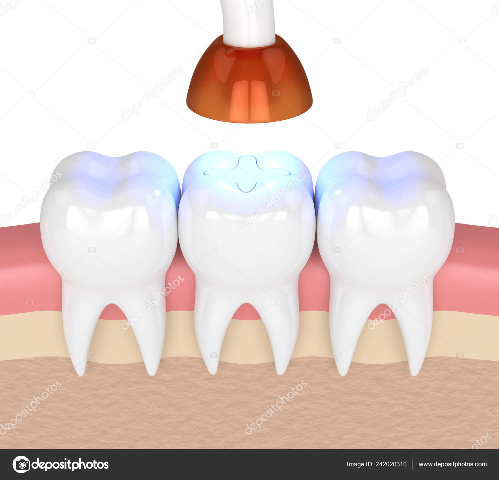 Render Teeth Dental Polymerization Lamp Light Cured Inlay Filling White ...