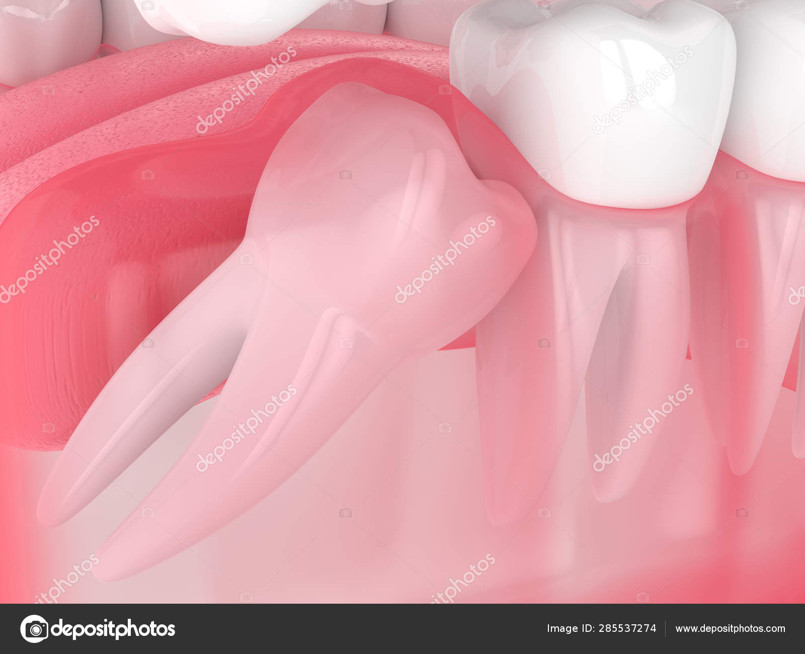 Fotos de 3d rendición de la mandíbula con la impactación mesial ...