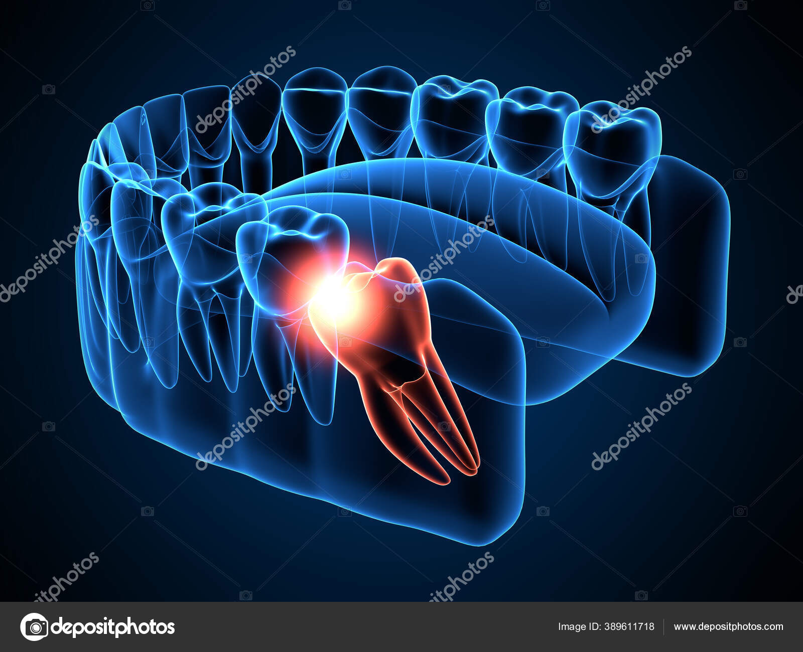 Render Jaw Ray Wisdom Mesial Impaction Concept Different Types Wisdom ...