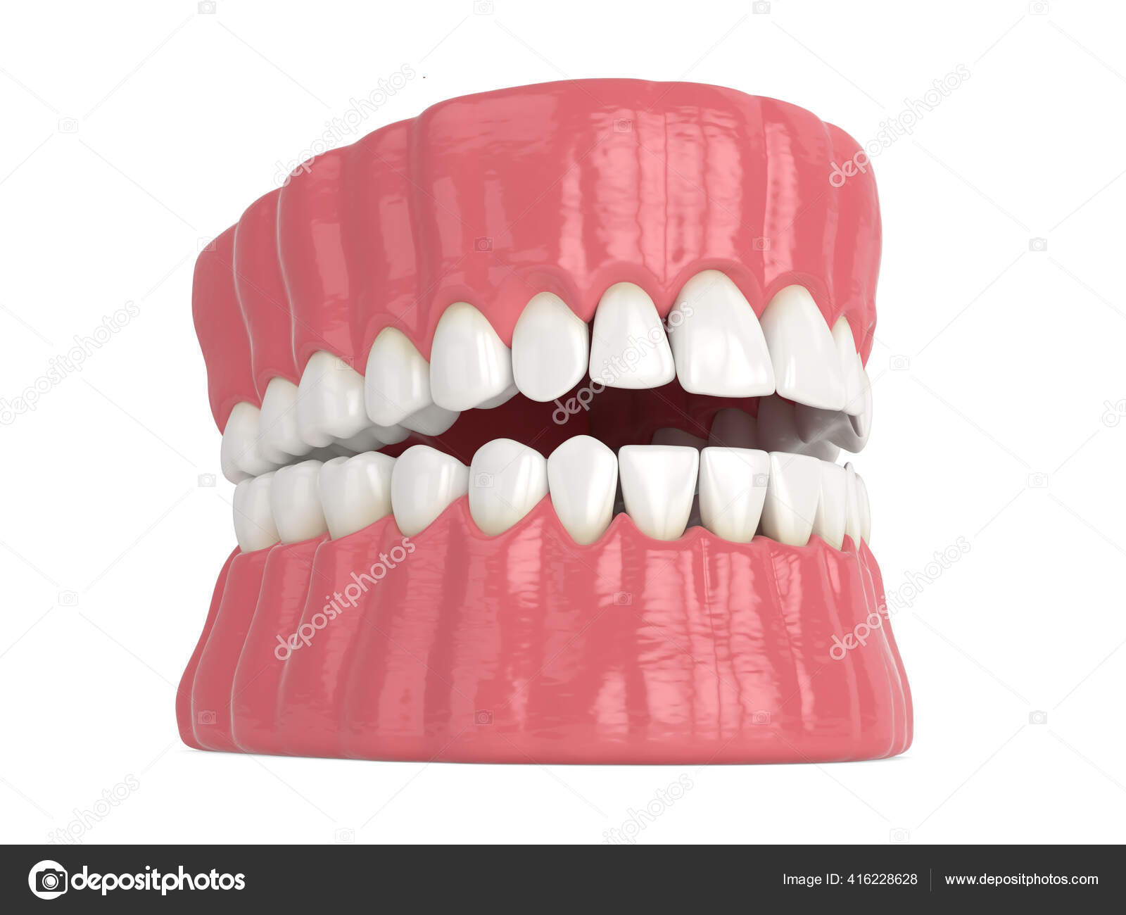 Render Human Jaw Black Triangles Teeth Isolated White Background Stock ...