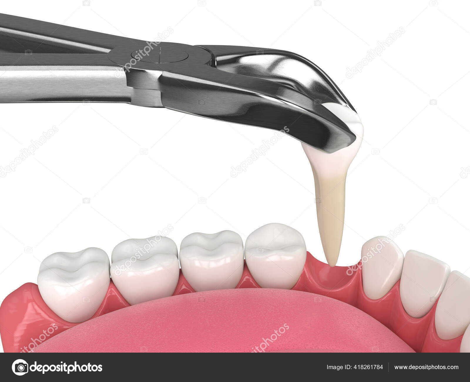 Render Lower Jaw Tooth Extracted Dental Forceps Stock Photo by ©ayo888 ...