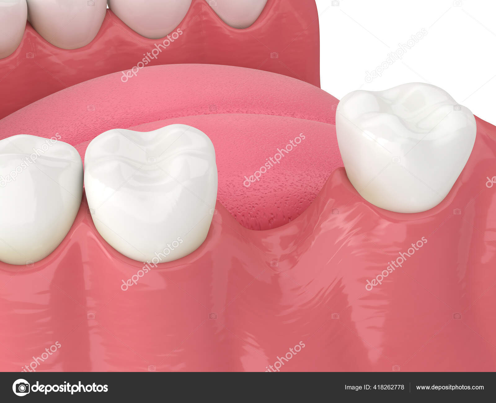 Render Jaw Bone Recession Loosing Tooth White Stock Photo by ©ayo888 ...