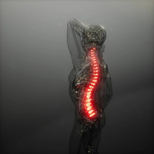 Backache in Back Bones - Stock Image - Everypixel