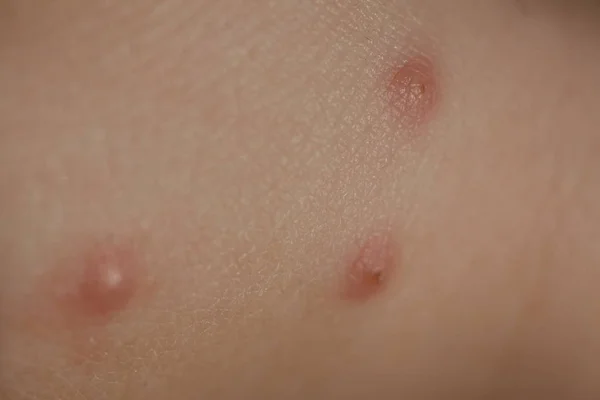 Bed Bug Bites On Babies