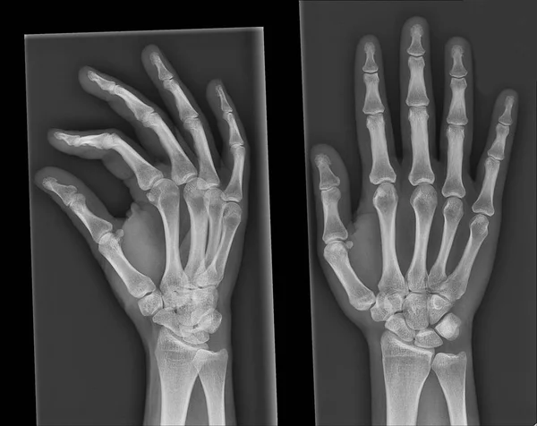 Imágenes: radiografia mano normal | Radiografía de manos (vista frontal ...