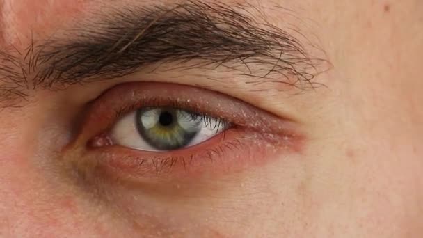 Human Scratches His Right Eye Inflammation Red Allergic Reaction ...