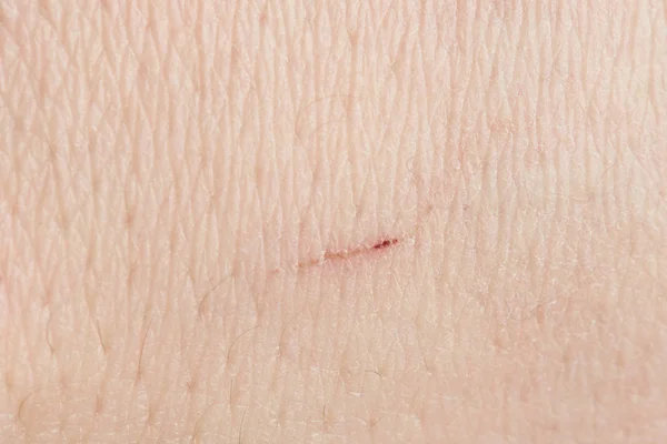 Skin cut Images - Search Images on Everypixel