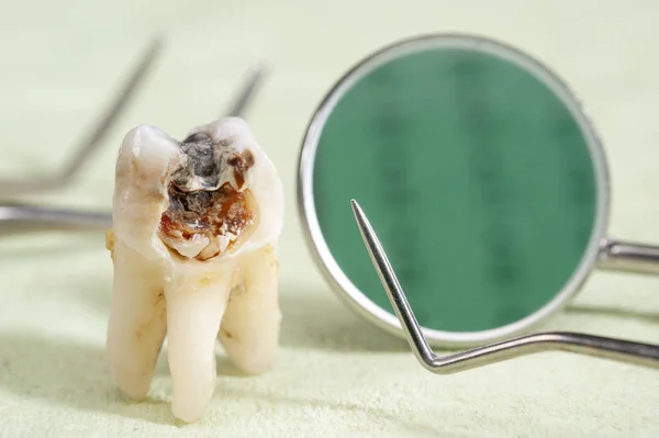 extracted molar tooth with caries and amalgam - Stock Image - Everypixel