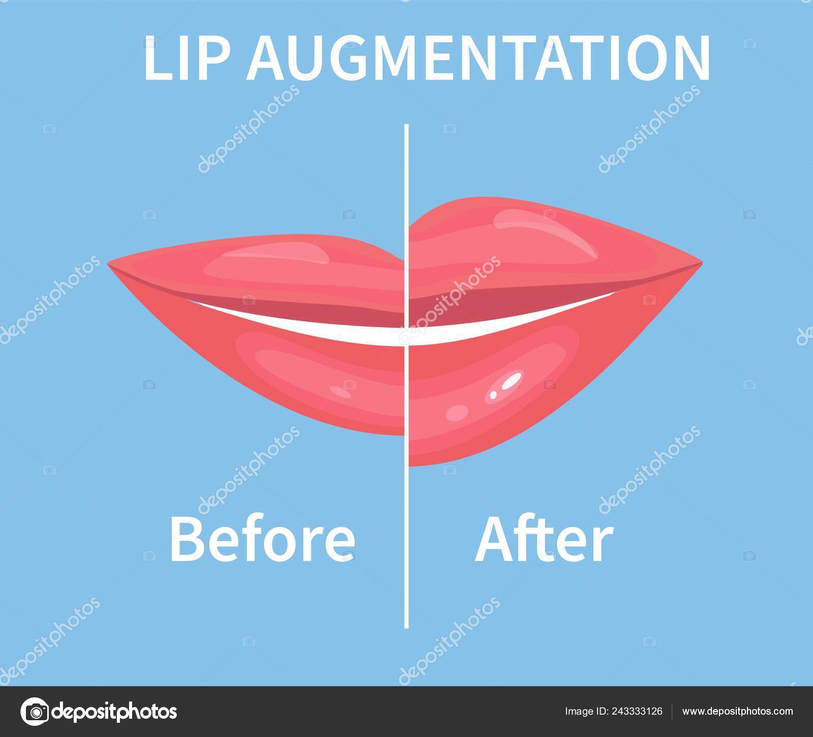 Aumento de labios. Antes y después de las inyecciones de relleno labial ...