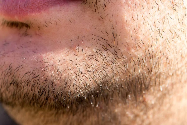 Rash on beard Stock Photos, Royalty Free Rash on beard Images ...