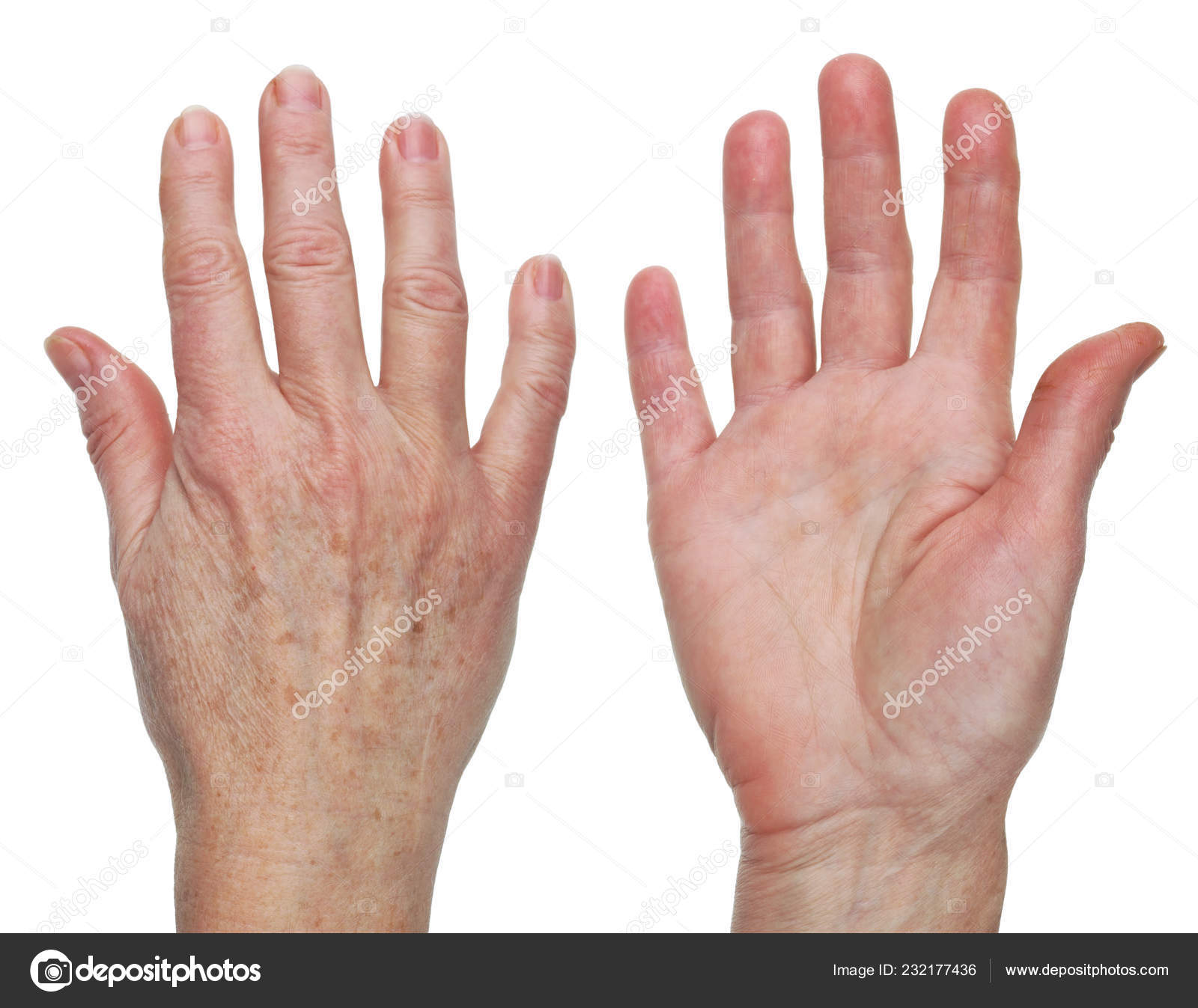 Sore Dry Skin Hand Old Woman Grandmother Isolated White Studio Stock ...