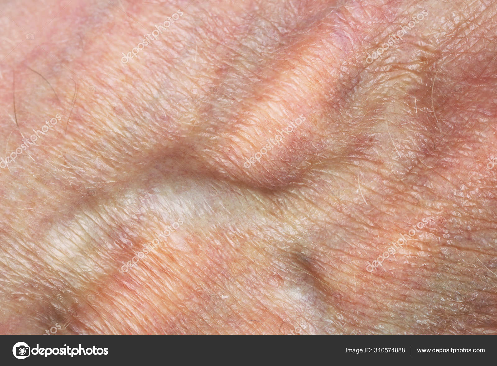 Bloated vein with blood and wrinkled dry skin on an elderly man — Stock ...