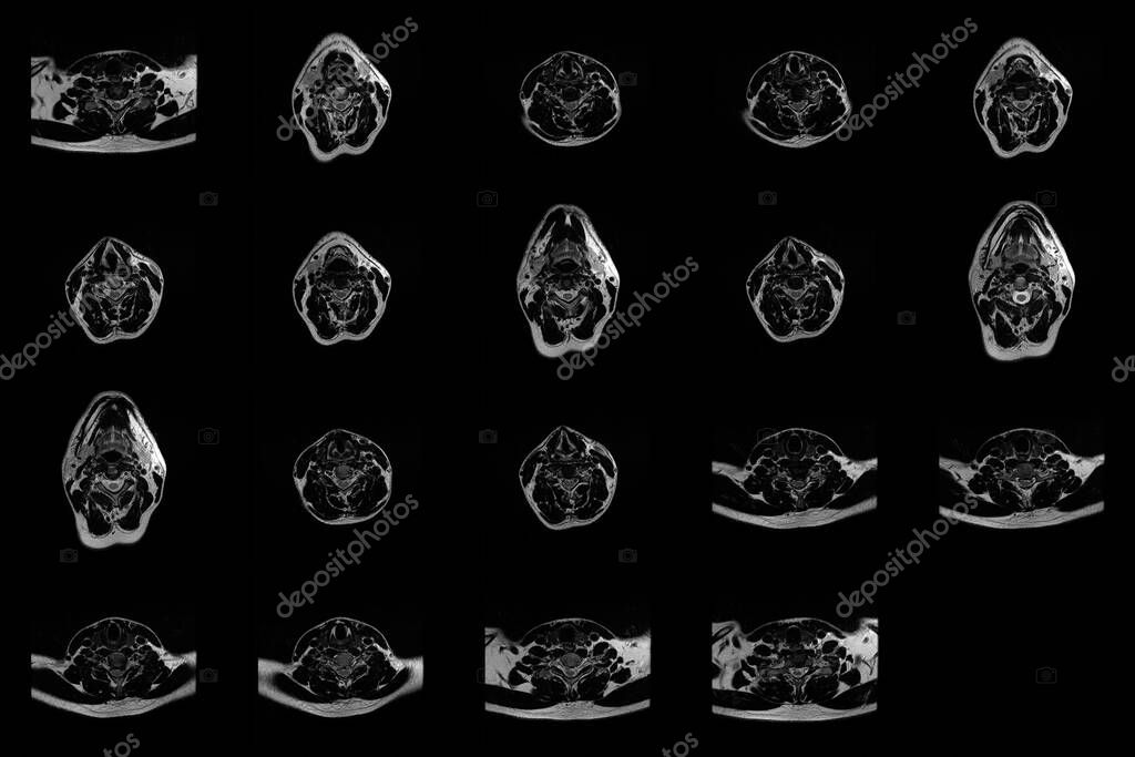 conjunto de resonancias magnéticas transversales del área del cuello ...