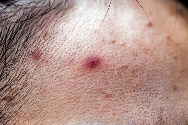 Scar skin Images - Search Images on Everypixel