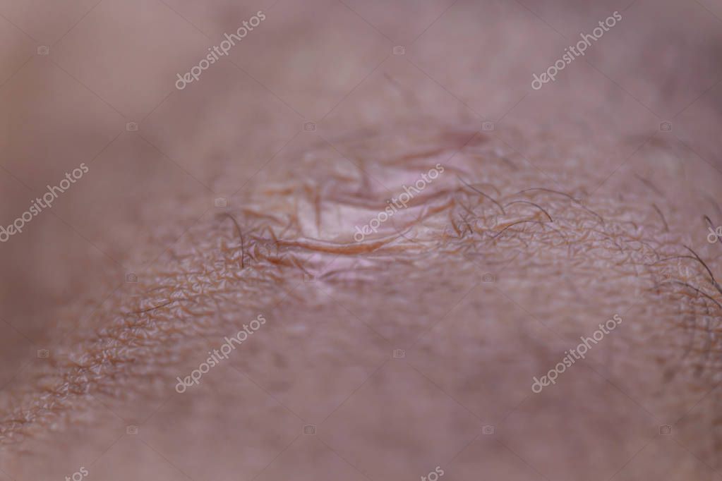 Primer plano de la cicatriz queloide cianótica causada por cirugía y sutura 2023