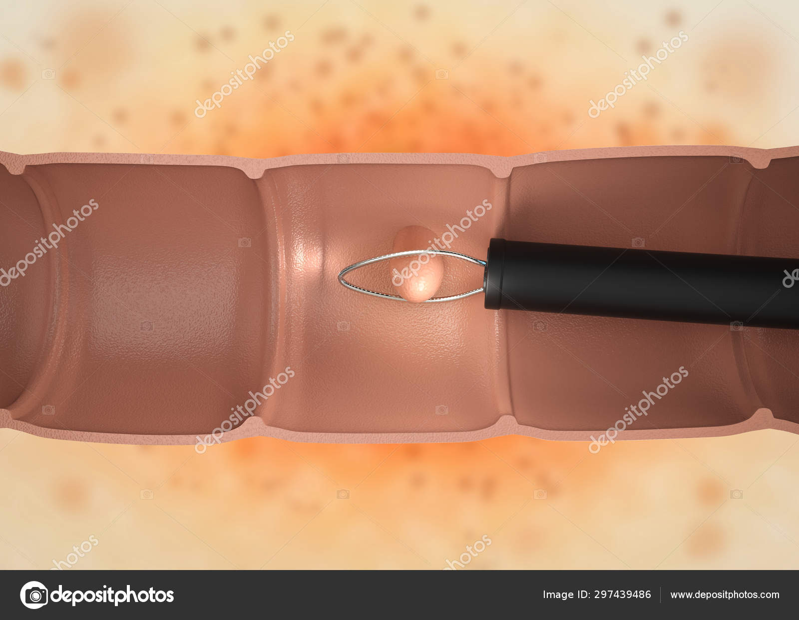 Endoscopio eliminar pólipo colónico — Foto de stock #297439486 © phonlamai