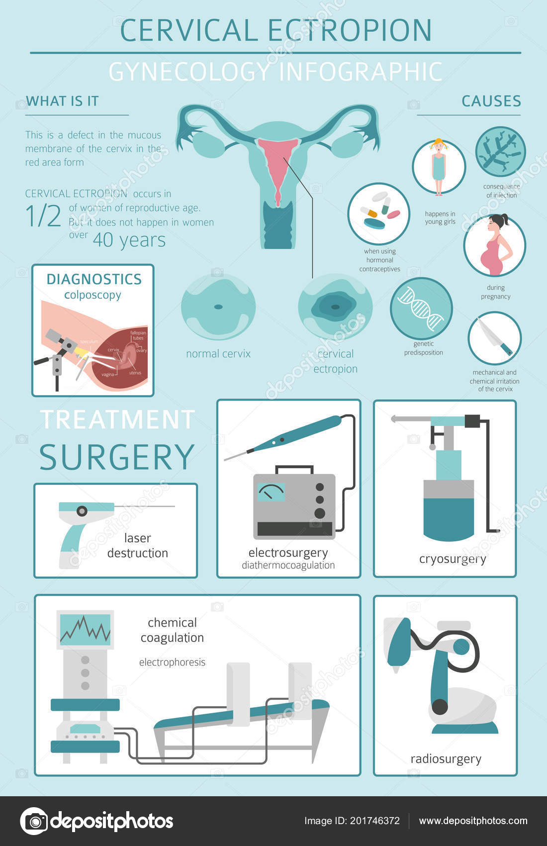 Ectropión Cervical Infografía Ginecológica Enfermedades Médicas ...