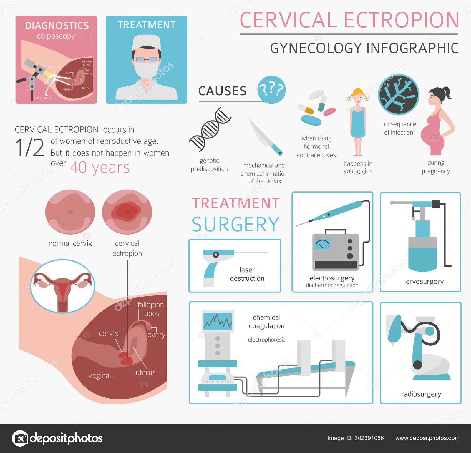 Ectropión Cervical Infografía Ginecológica Enfermedades Médicas ...