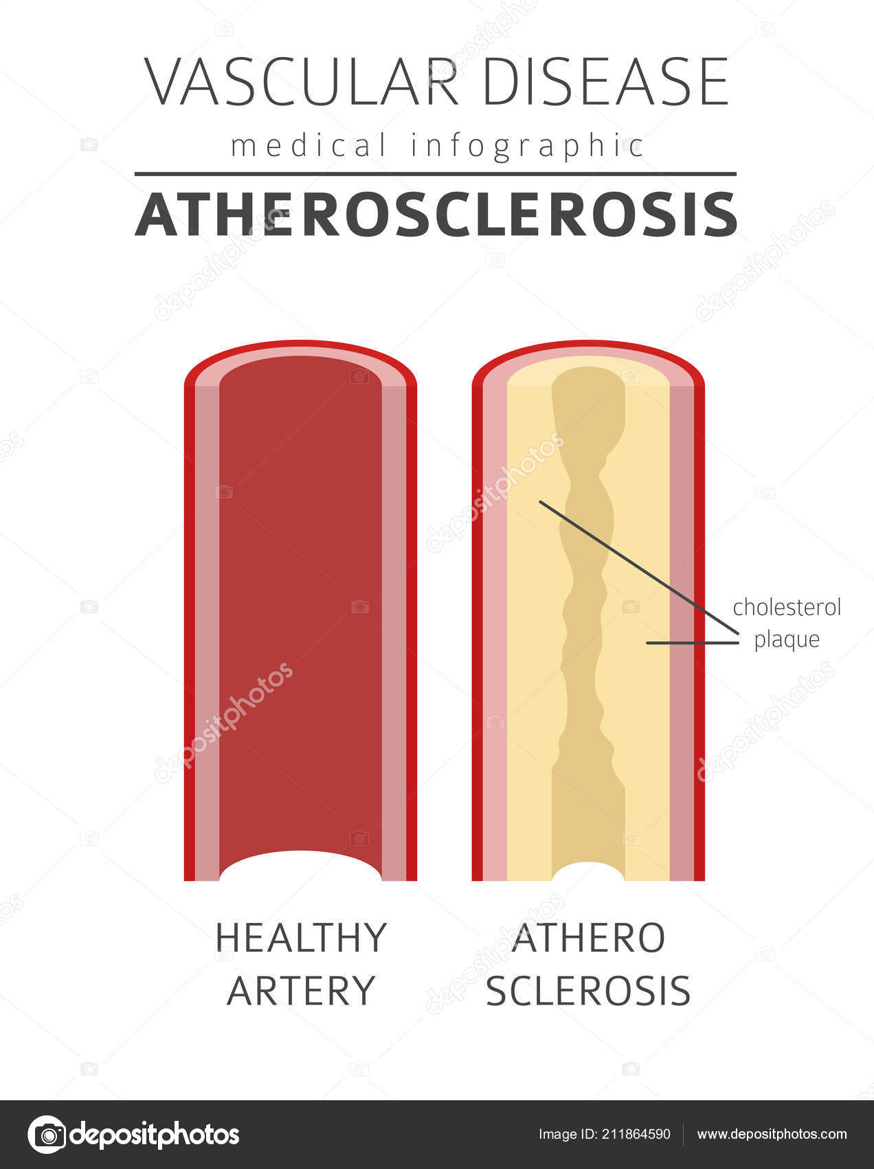 Image vectorielle Maladies Vasculaires Symptômes D'athérosclérose ...