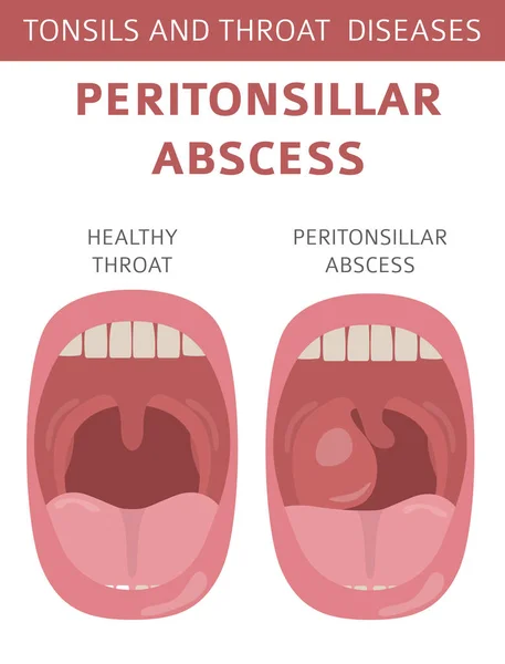 18,239,749 Peritonsillar abscess Vector Images | Depositphotos