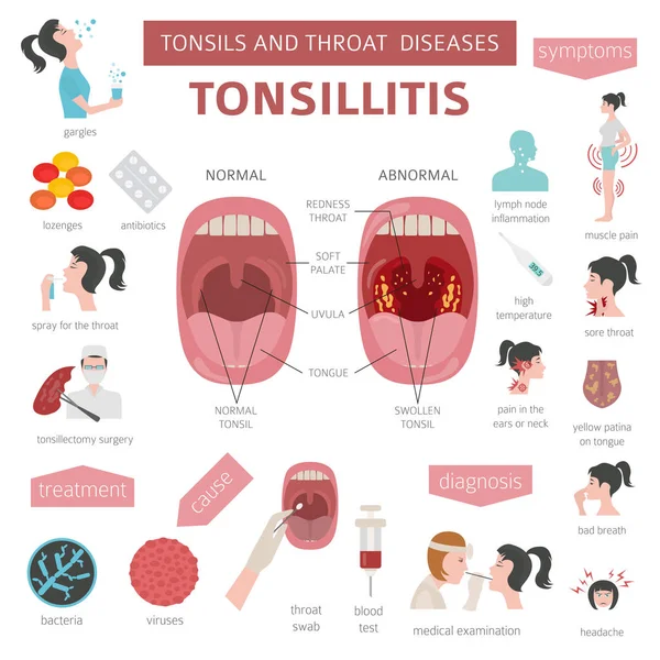 549 Tonsil Vector Images | Depositphotos
