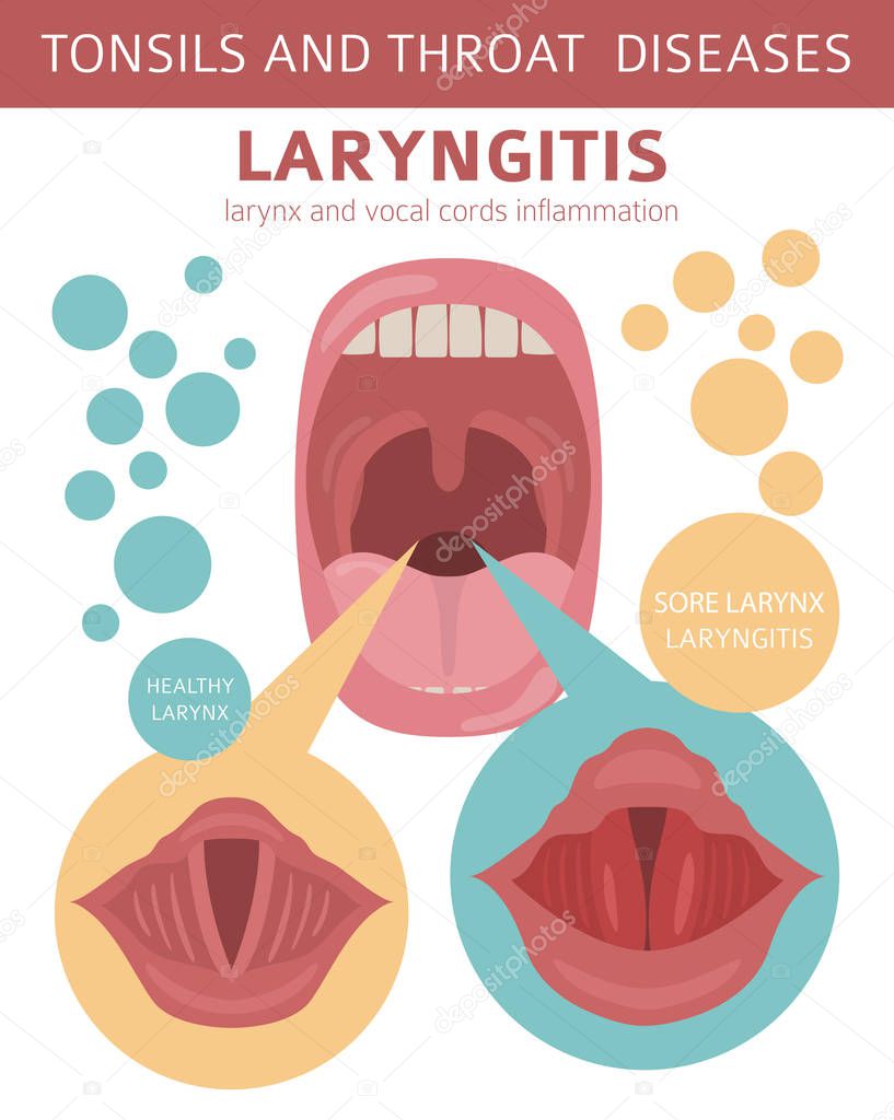 Amígdalas y enfermedades de la garganta. Síntomas de laringitis ... Amígdalas y enfermedades de la garganta. Síntomas de laringitis ...