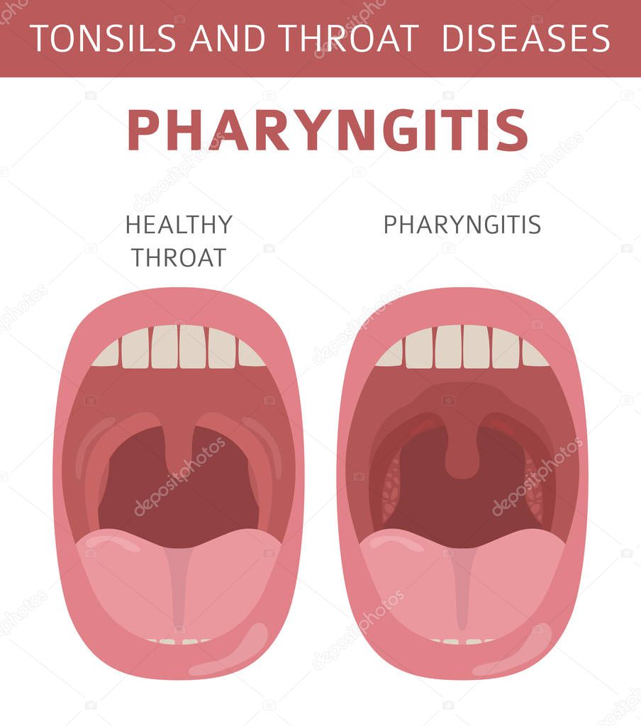 Streptokoksik Farenjit Diyagramı