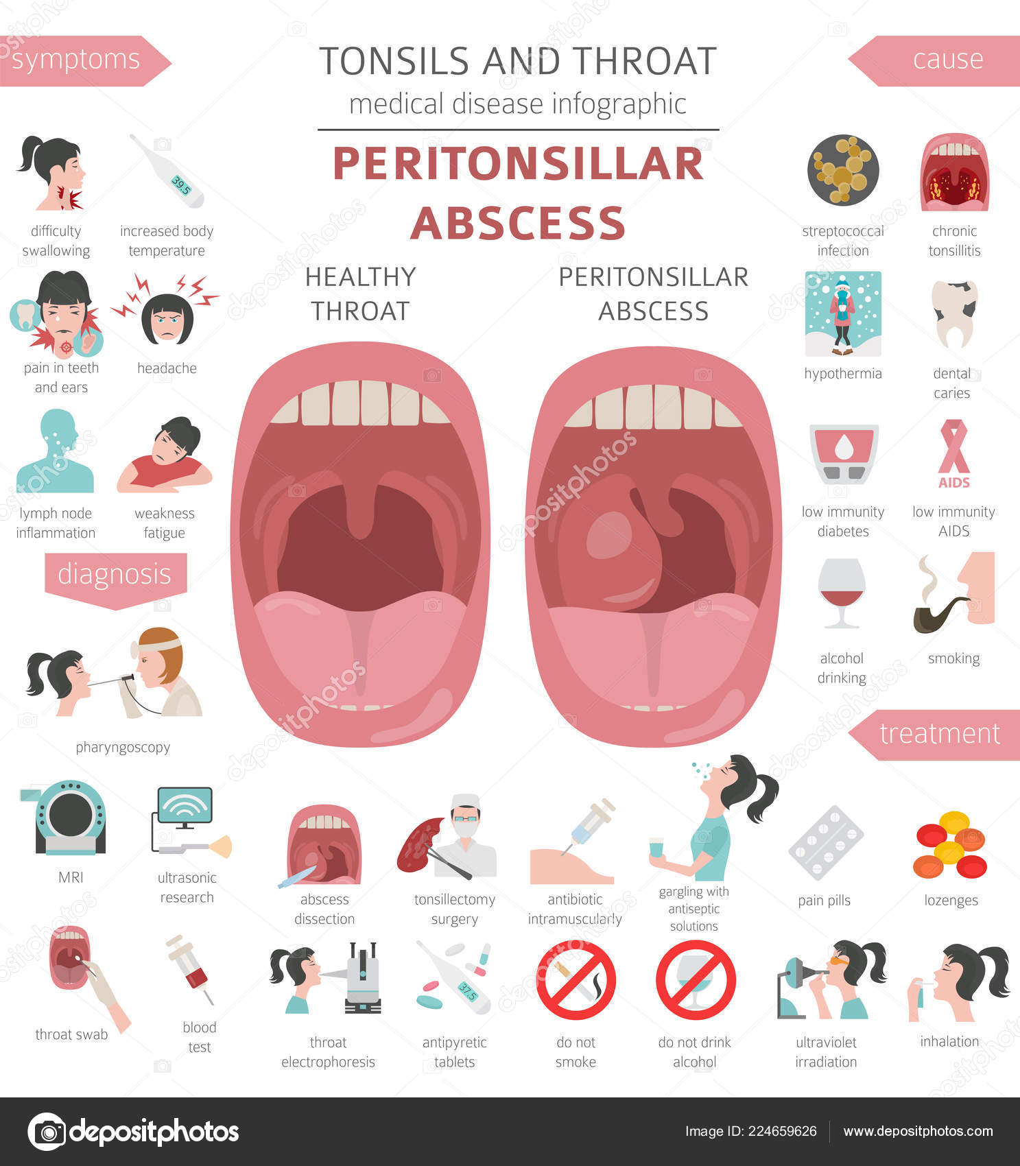 Streptokokken Keel Clipart Keelabces (peritonsillair Abces) KNO