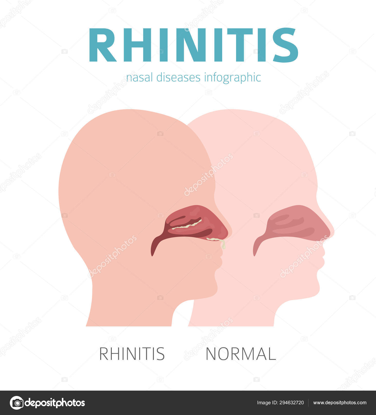 Burun hastalıkları. Rinit belirtileri, tedavi simgesi. Tıbbi i ©A7880S ...