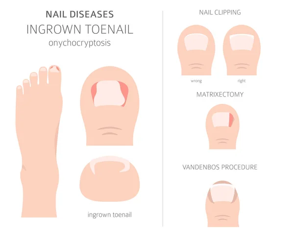 ᐈ Ingrown toenail stages stock pictures, Royalty Free ingrown toenail ...