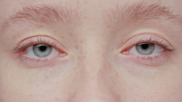 Albinism eye Stock Photos, Royalty Free Albinism eye Images | Depositphotos