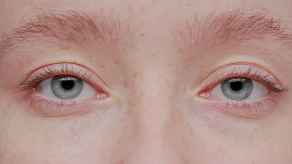 Albinism eye Stock Photos, Royalty Free Albinism eye Images | Depositphotos