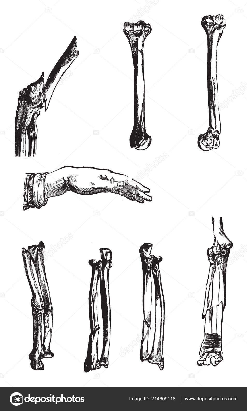 Illustration Represents Bone Fractures Vintage Line Drawing Engraving ...