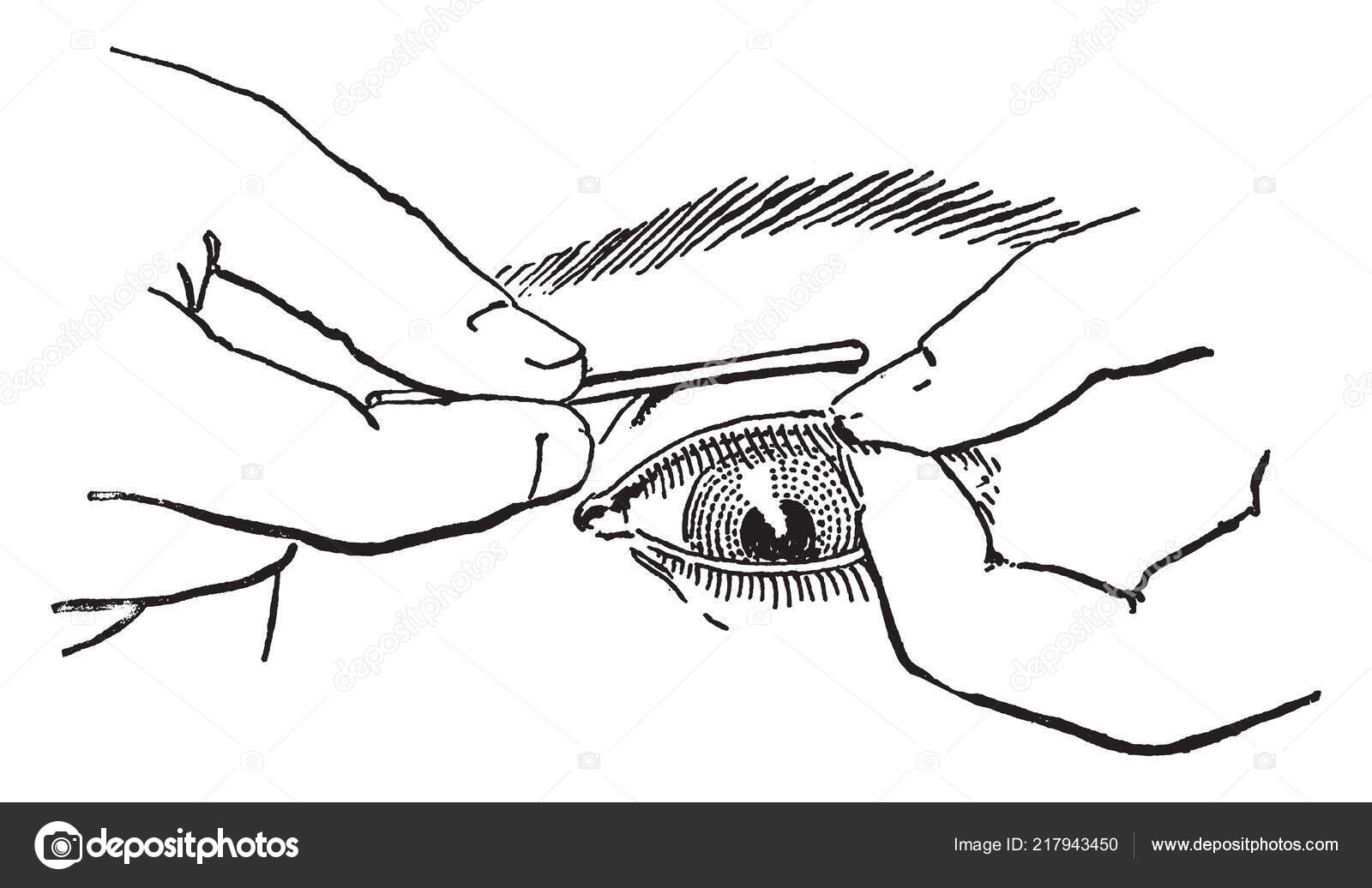 Illustration Represents Everted Eyelid Vintage Line Drawing Engraving ...