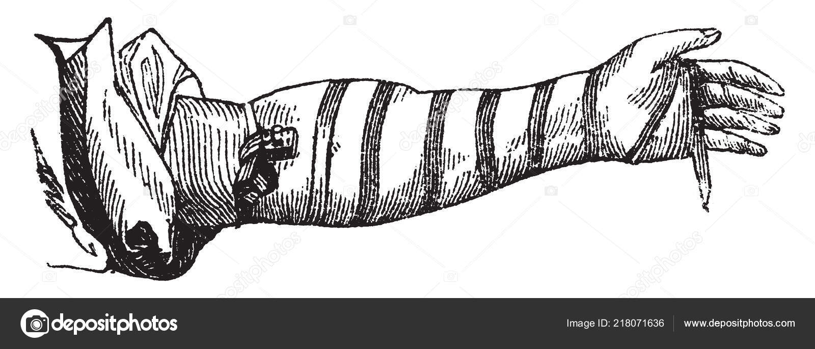 Wrapped Arm Has Hand Images Vintage Line Drawing Engraving Illustration ...