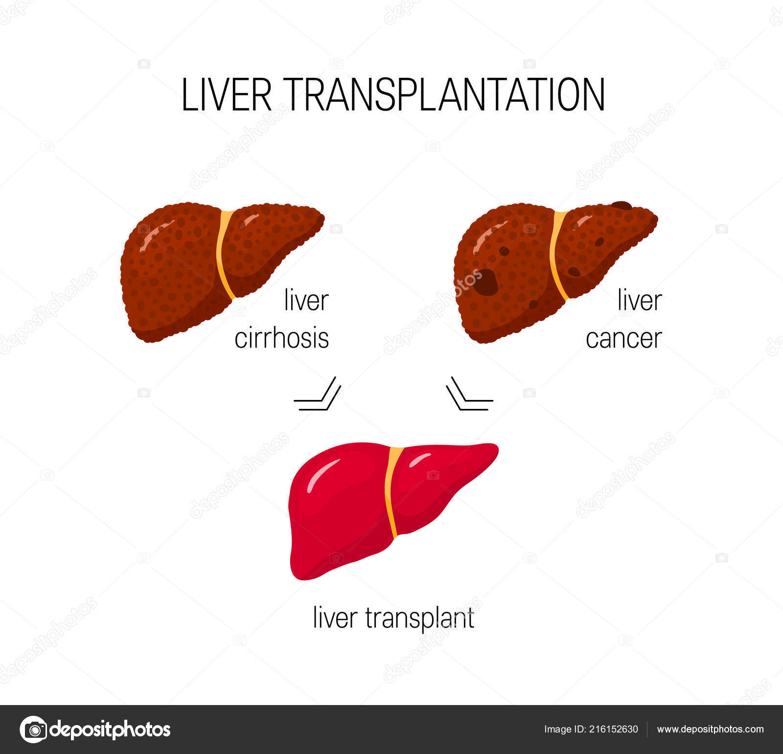 Conceito Transplante Fígado Estilo Cartoon imagem vetorial de marina_ua ...