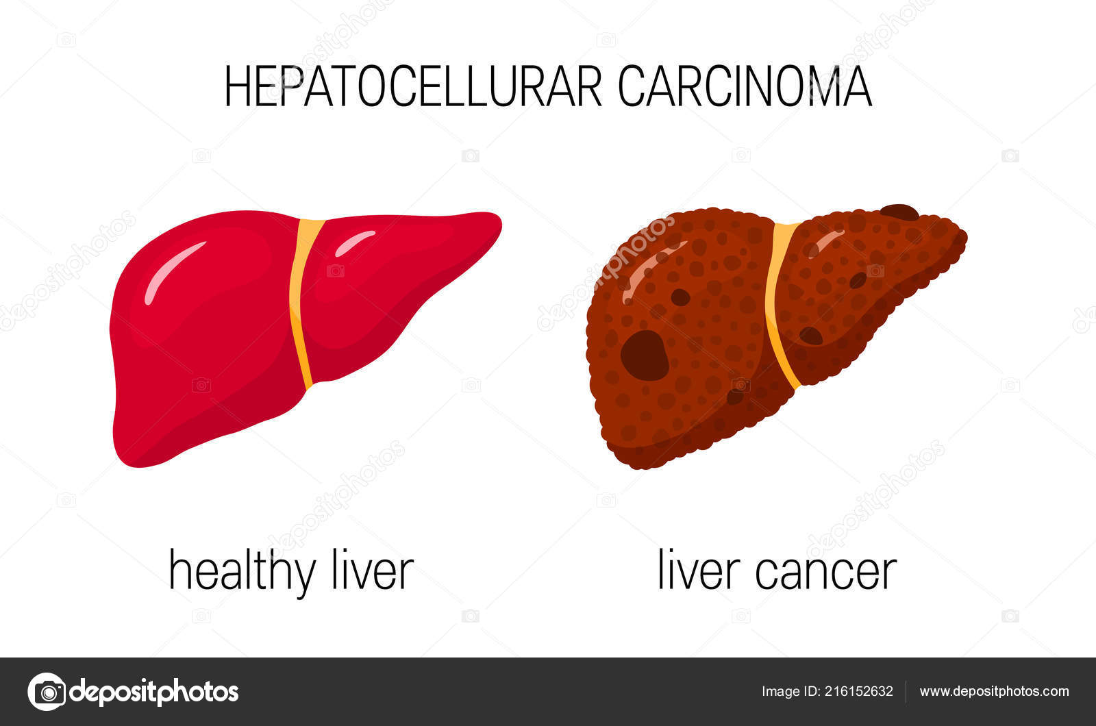 Hepatocellurar Carcinoma Concept Vector Illustration Healthy Hcc Liver ...