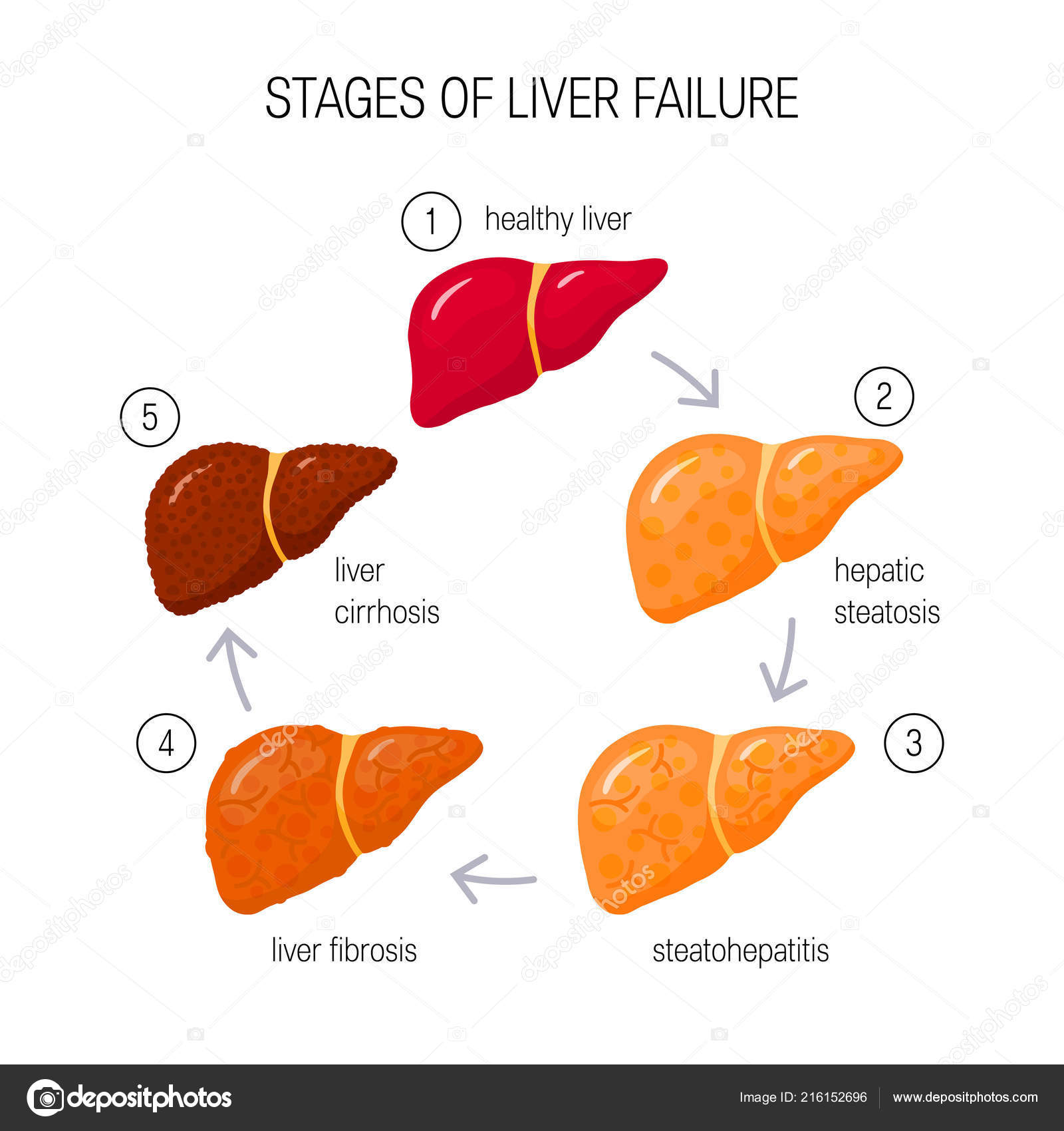 Stages Of Liver Damage Liver Disease Healthy Fatty Liver Fibrosis And ... Stages Of Liver Damage Liver Disease Healthy Fatty Liver Fibrosis And ...