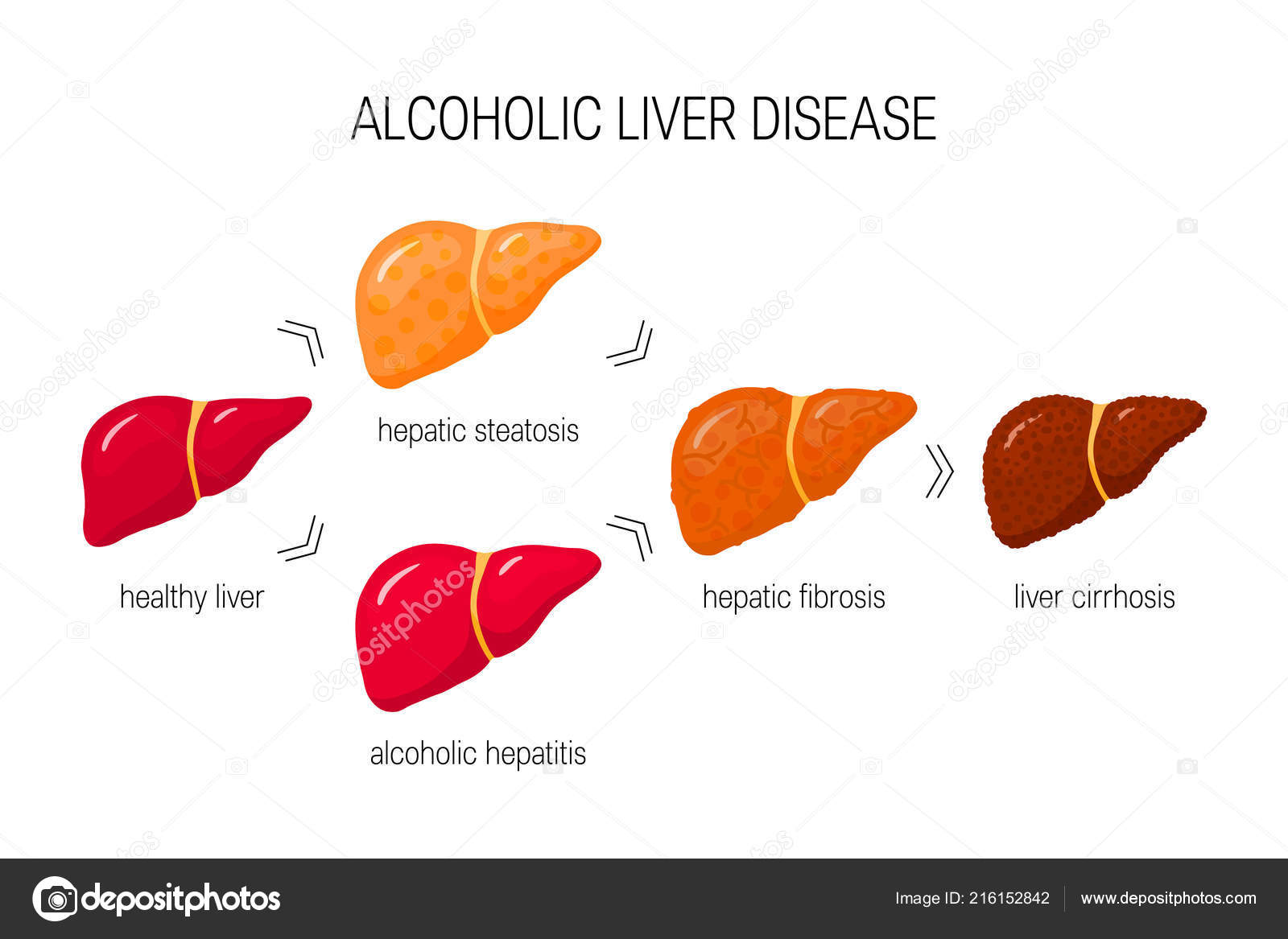 Etapas Enfermedad Hepática Alcohólica Ilustración Vectorial Hígado Sano