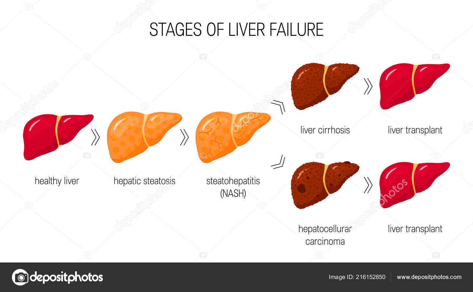 Etapas Del Concepto Insuficiencia Hepática Ilustración Vectorial Hígado ...