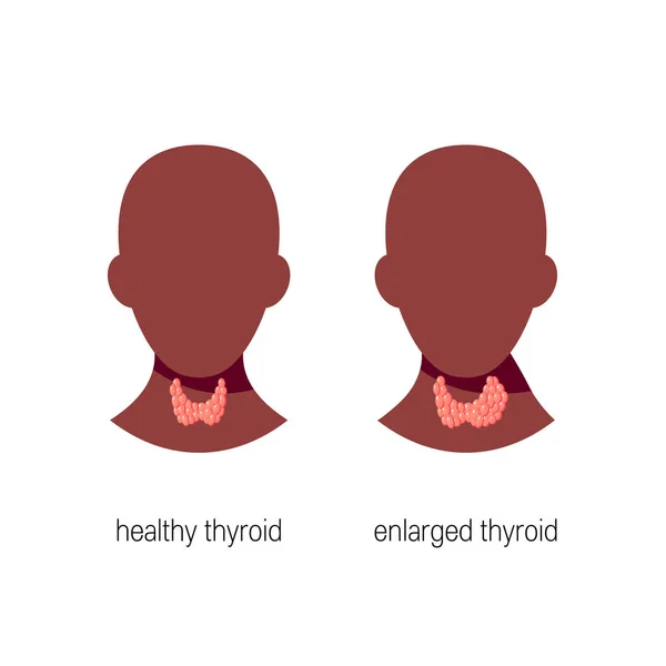 ᐈ Goiter stock pictures, Royalty Free goitre vectors | download on ...