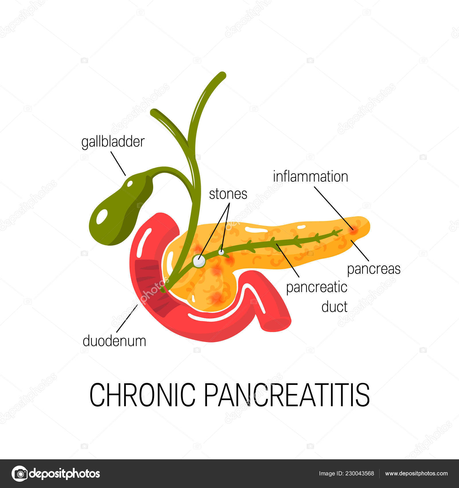 Chronic pancreatitis concept. Vector illustration Stock Vector Image by ...