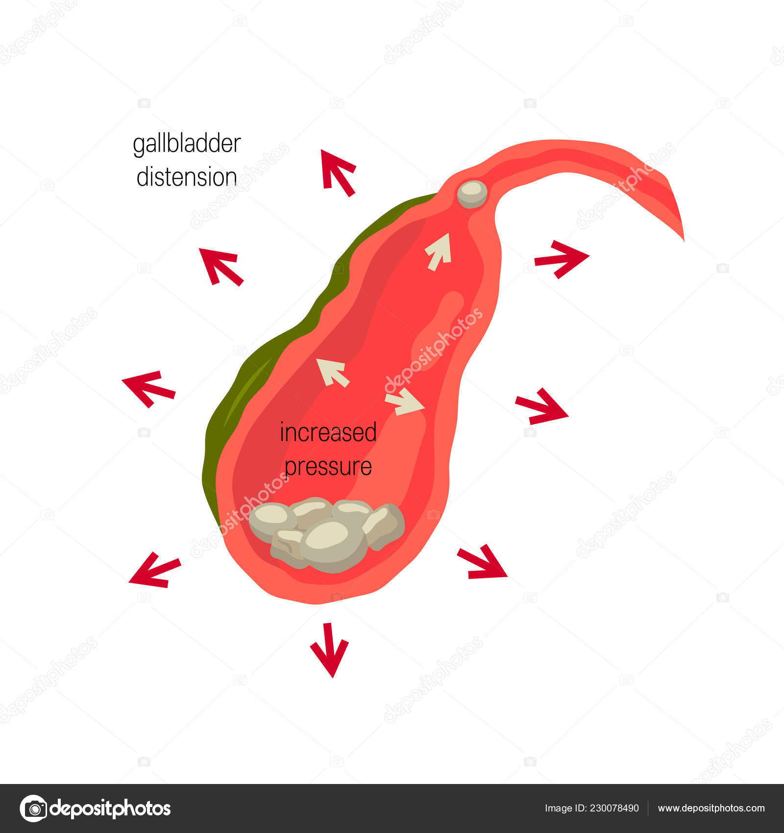 Vesícula biliar inflamada, concepto de colelitiasis Vector de stock por ...