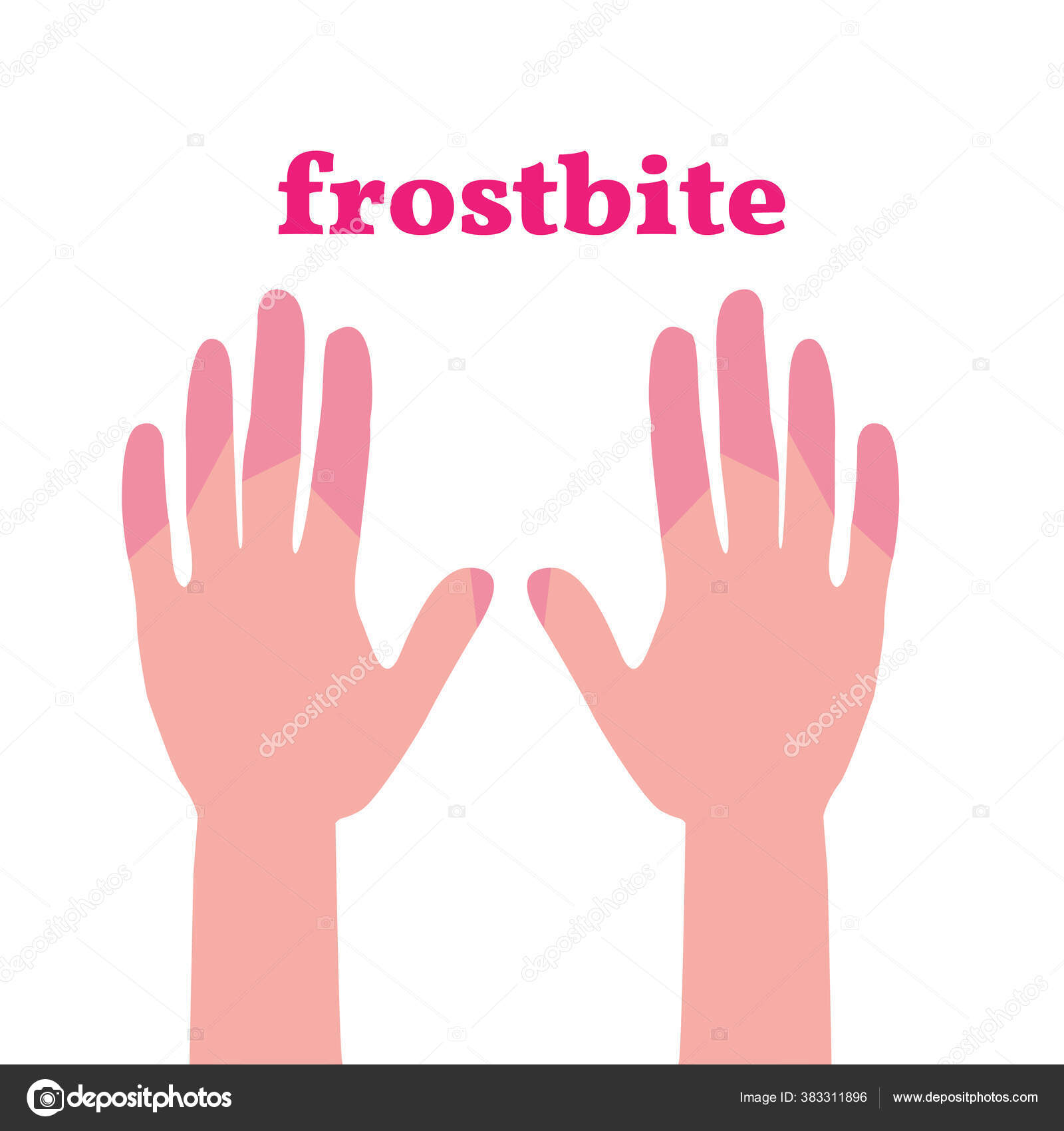 Frostbite. Hands with different skin colors due to low temperature and ...